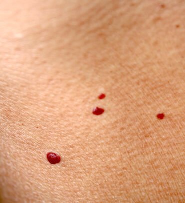 Le Vasculyse (thermocoagulation) - La Clinique GG